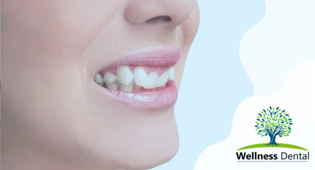 How to Fix a Crossbite: Understanding the Symptoms and Treatment Options